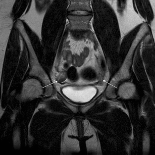 Clinical value of magnetic resonance imaging in patients with Mayer ...