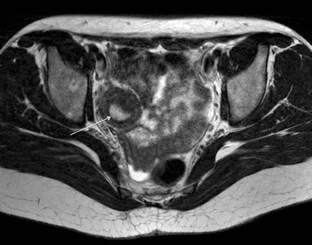 Clinical value of magnetic resonance imaging in patients with Mayer ...
