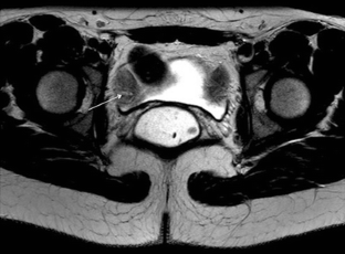 Clinical value of magnetic resonance imaging in patients with Mayer ...