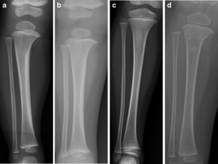Tibial bowing in children - what is normal? a radiographic study ...