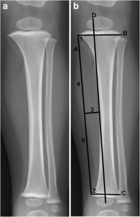 Tibial bowing in children - what is normal? a radiographic study ...