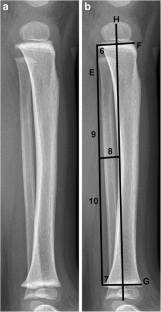 Tibial bowing in children - what is normal? a radiographic study ...