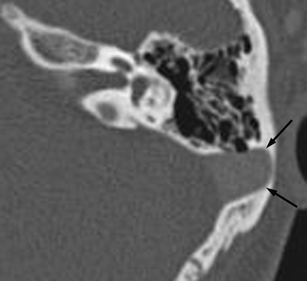 CT evaluation of sigmoid plate dehiscence causing pulsatile tinnitus ...