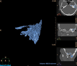CT evaluation of sigmoid plate dehiscence causing pulsatile tinnitus ...