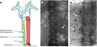 The thoracic duct: clinical importance, anatomic variation, imaging ...