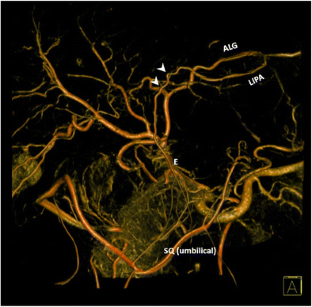 Arteries of the falciform ligament on C-arm CT hepatic arteriography ...
