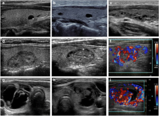 Prospective validation of the ultrasound based TIRADS (Thyroid Imaging ...