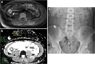 Assessment of patency capsule retention using MR diffusion-weighted ...