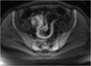Assessment of patency capsule retention using MR diffusion-weighted ...