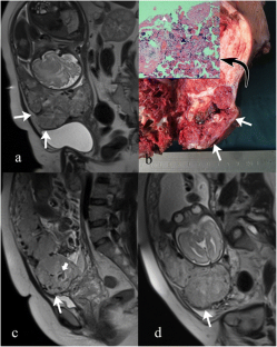 Invasive placenta previa: Placental bulge with distorted uterine ...