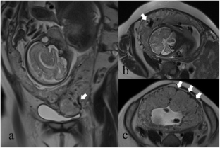 Invasive placenta previa: Placental bulge with distorted uterine ...