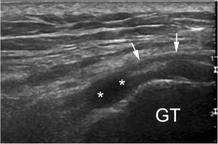 Clinical indications for musculoskeletal ultrasound updated in 2017 by ...