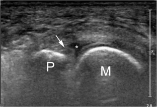 Clinical indications for musculoskeletal ultrasound updated in 2017 by ...