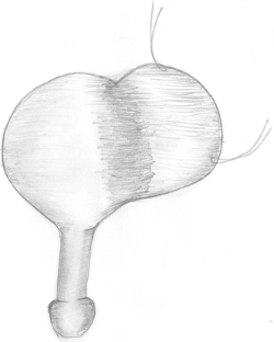 Management of bladder exstrophy epispadias complex in adults: is ...