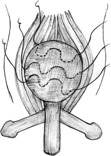 Management of bladder exstrophy epispadias complex in adults: is ...