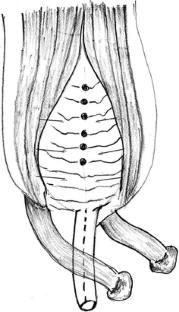 Management of bladder exstrophy epispadias complex in adults: is ...