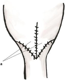 The T-plasty: a modified YV-plasty for highly recurrent bladder neck ...