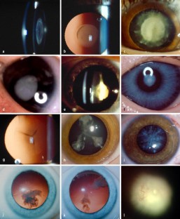 Genetische Untersuchungen bei kongenitaler Katarakt | SpringerLink