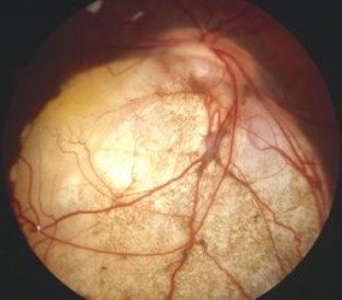 Ablatio retinae bei Kindern und Jugendlichen | SpringerLink