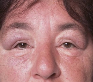 Morbus Morbihan | SpringerLink