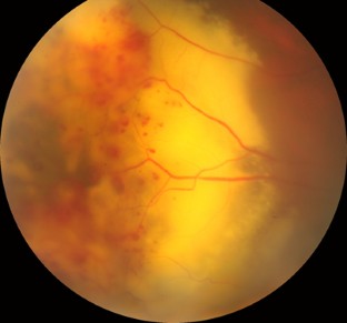 Morbus Coats | SpringerLink