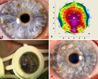 Update: Tiefe anteriore lamelläre Keratoplastik (DALK) bei Keratokonus ...