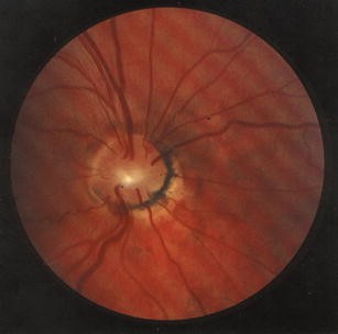 Morning glory syndrome and basal encephalocele | SpringerLink