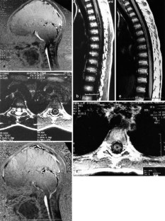 Surgical results of posterior fossa decompression for patients with ...
