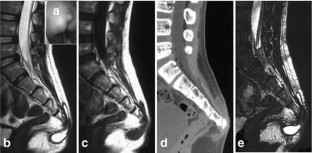 Bursal cyst (bursitis) of the coccygeal region clinically mimics ...