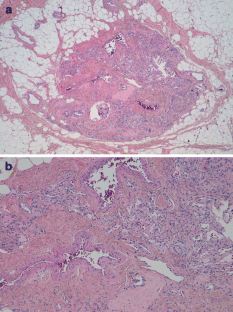 Spinal dermal sinus and pseudo-dermal sinus tracts : two different ...