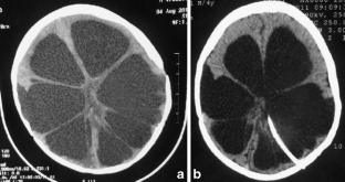 Multiloculated hydrocephalus | SpringerLink