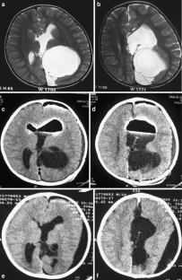 Multiloculated hydrocephalus | SpringerLink