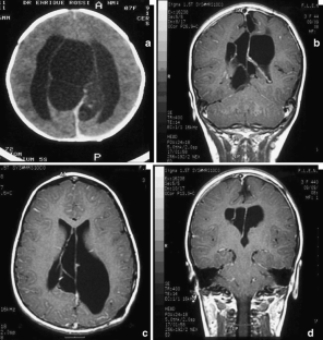 Multiloculated hydrocephalus | SpringerLink