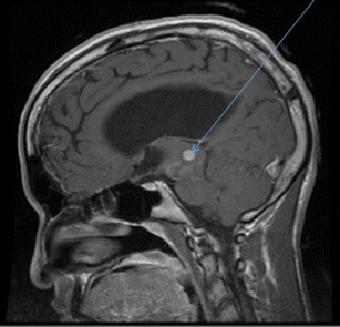Tectal plate gliomas: a review | SpringerLink