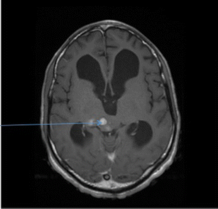 Tectal plate gliomas: a review | SpringerLink