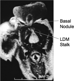Limited dorsal myeloschisis: a not-so-rare form of primary neurulation ...