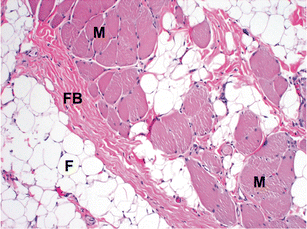 Limited dorsal myeloschisis: a not-so-rare form of primary neurulation ...