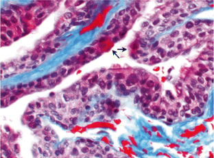 Limited dorsal myeloschisis: a not-so-rare form of primary neurulation ...