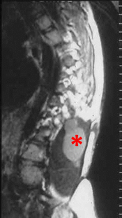 A practical clinical classification of spinal neural tube defects ...