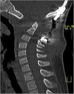 The odontoid process: a comprehensive review of its anatomy, embryology ...