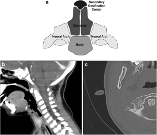 The odontoid process: a comprehensive review of its anatomy, embryology ...