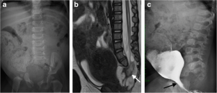 Sacrum agenesis and scimitar sacrum in Currarino syndrome | SpringerLink