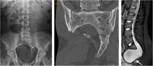 Sacrum agenesis and scimitar sacrum in Currarino syndrome | SpringerLink