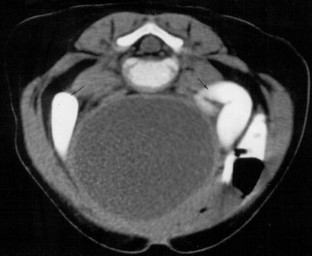 Two cases of pyometrocolpos due to distal vaginal atresia | SpringerLink