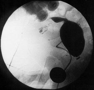 Two cases of pyometrocolpos due to distal vaginal atresia | SpringerLink