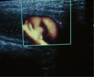High flow priapism: diagnosis and treatment in pediatric population ...