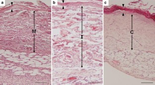 Matriderm ® 1 mm versus Integra ® Single Layer 1.3 mm for one-step ...