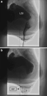 Dynamic defecography in the diagnosis of paediatric rectal prolapse and ...