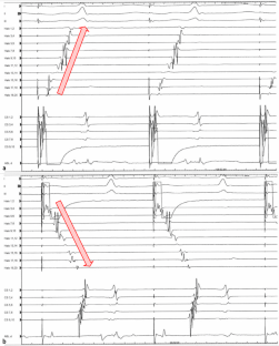 Typisches Vorhofflattern | SpringerLink
