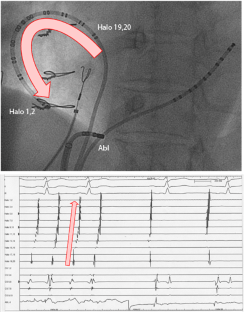 Typisches Vorhofflattern | SpringerLink